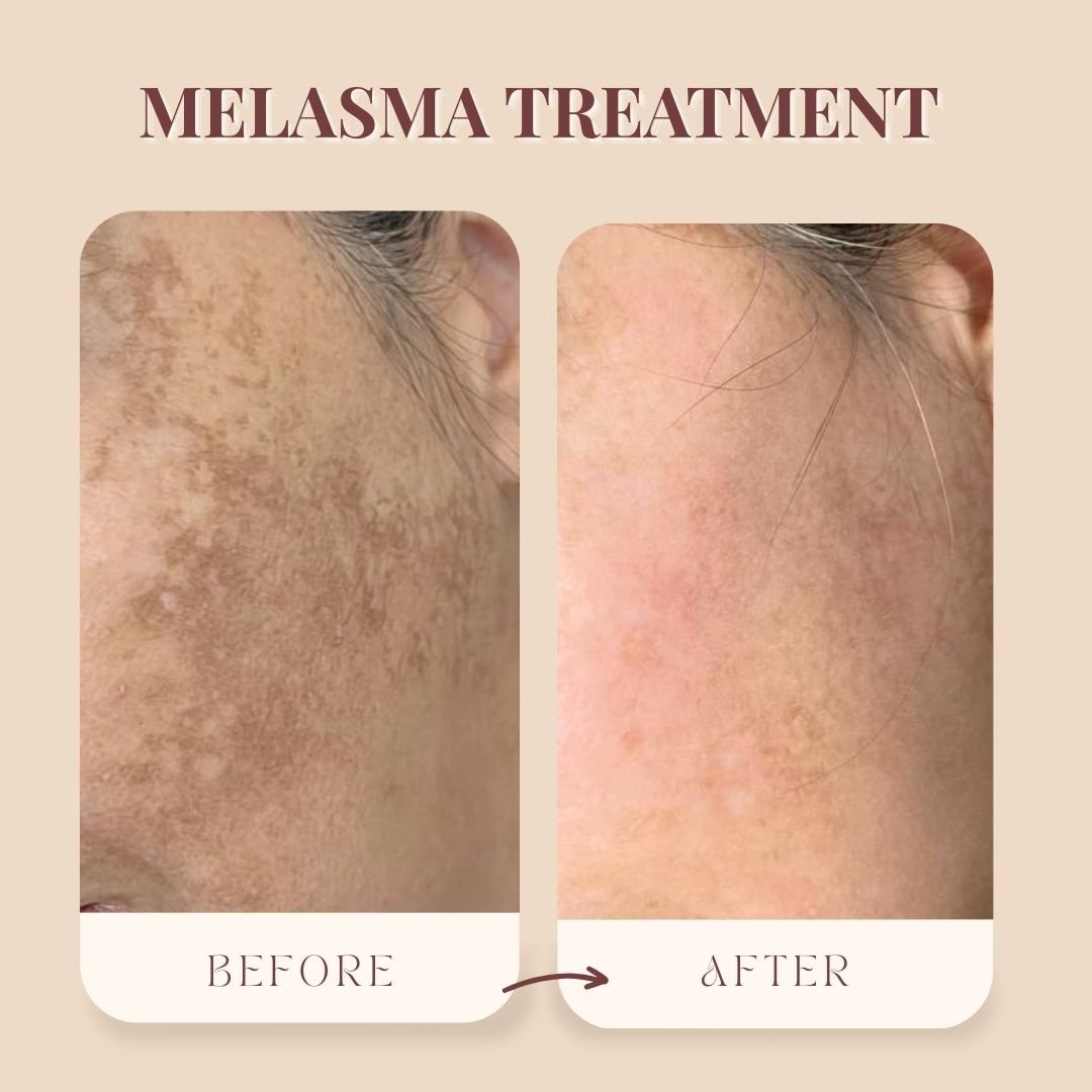 Pico Laser vs Q-Switch Laser: Which Treatment is Right for Your Skin ...